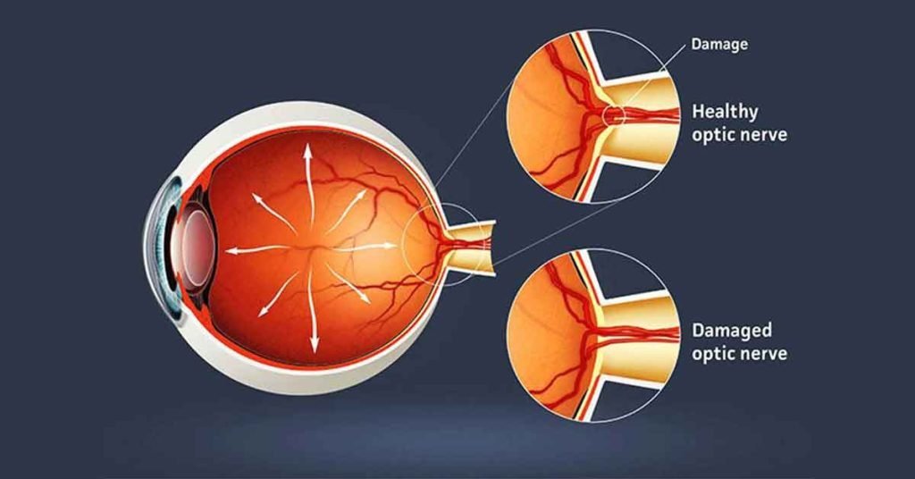 Explore Optic Neuropathy Stem Cell Treatment In Delhi, India
