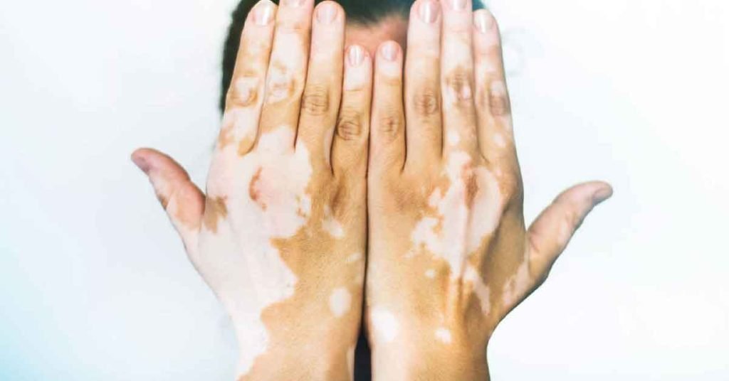 Vitiligo Stem Cell Treatment In Delhi, India | Stem Cell Therapy For ...