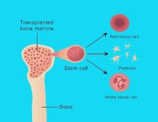 A Guide to Bone Marrow Transplants for Anemia in India