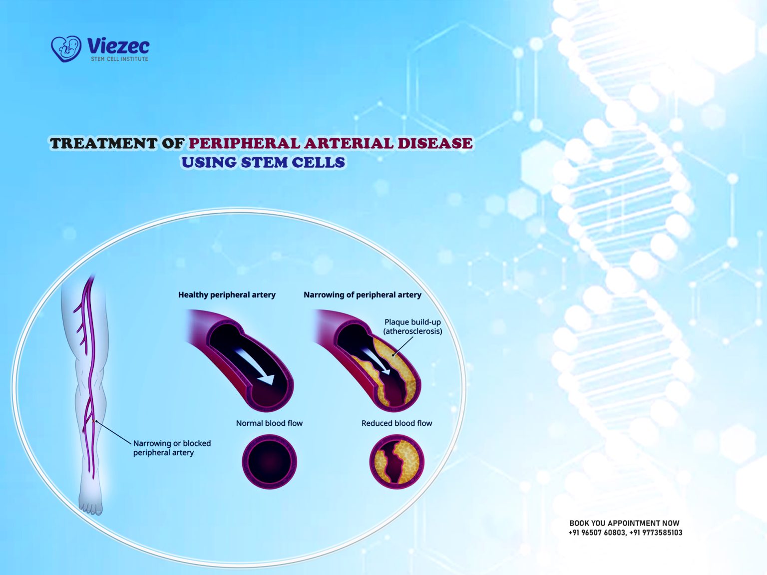 Treatment Of Peripheral Arterial Disease Using Stem Cells