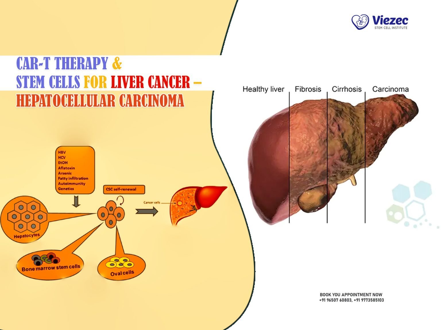CAR-T Therapy & Stem Cells For Liver Cancer – Hepatocellular Carcinoma