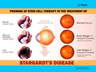 Promise Of Stem Cell Therapy In Stargardt’s Disease