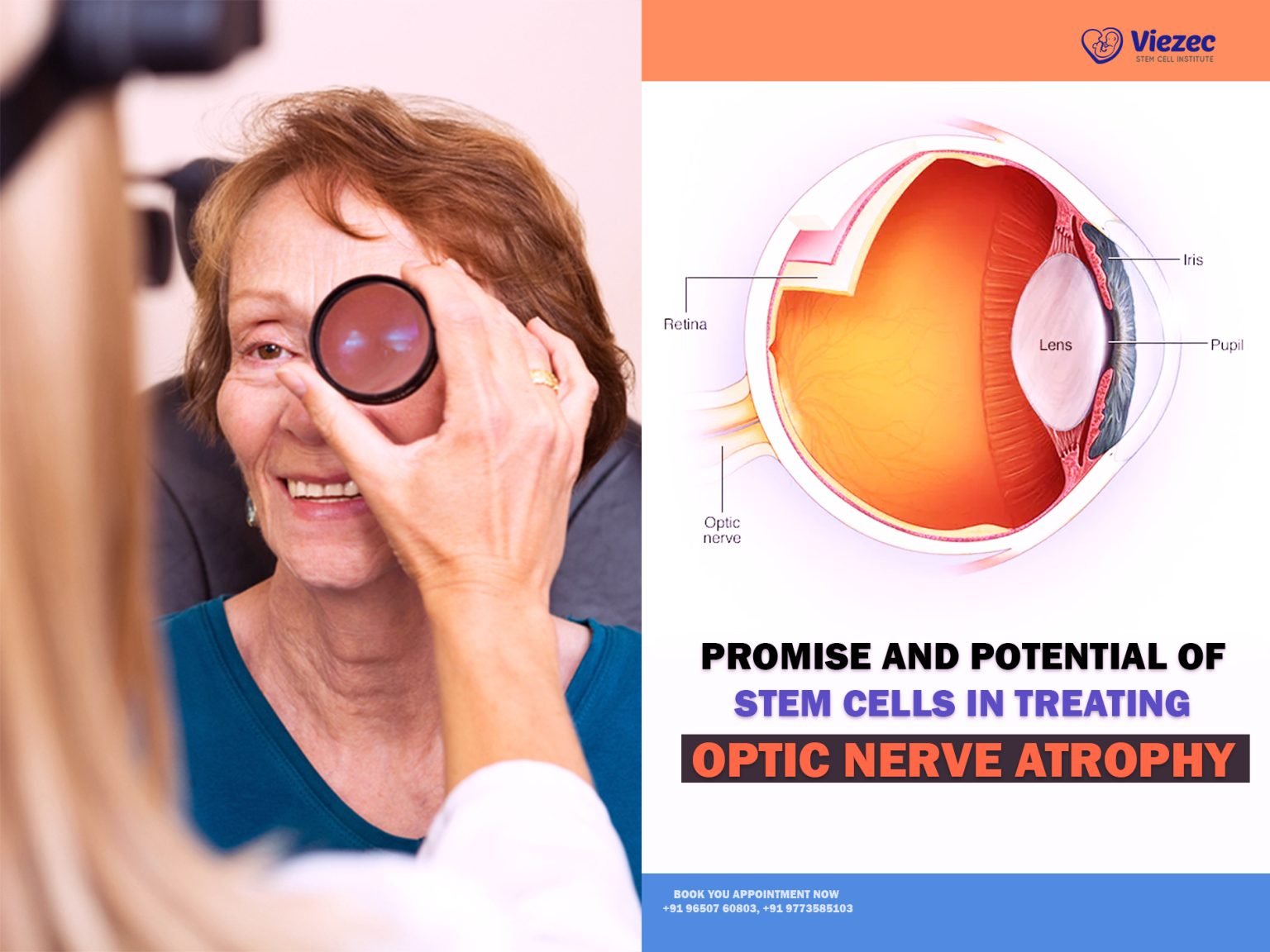 Potential of Stem Cells in Treating Optic Nerve Atrophy