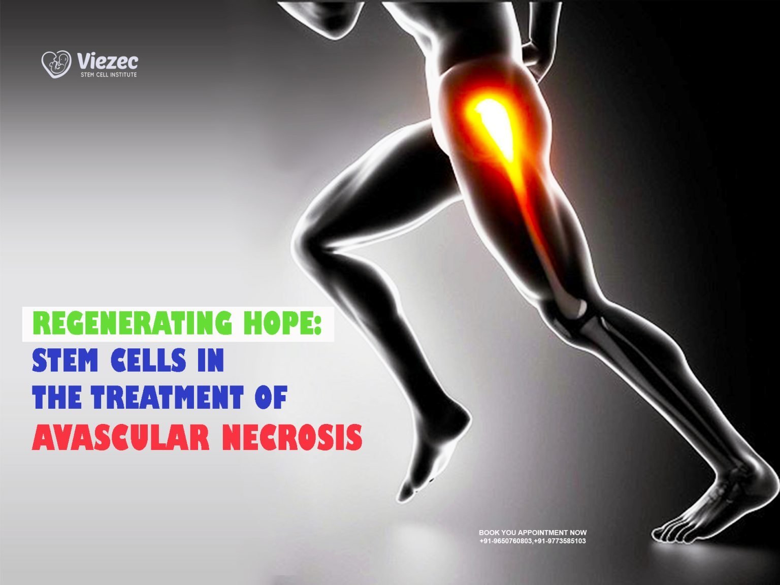 Regenerating Hope: Stem Cells Treatment Of Avascular Necrosis