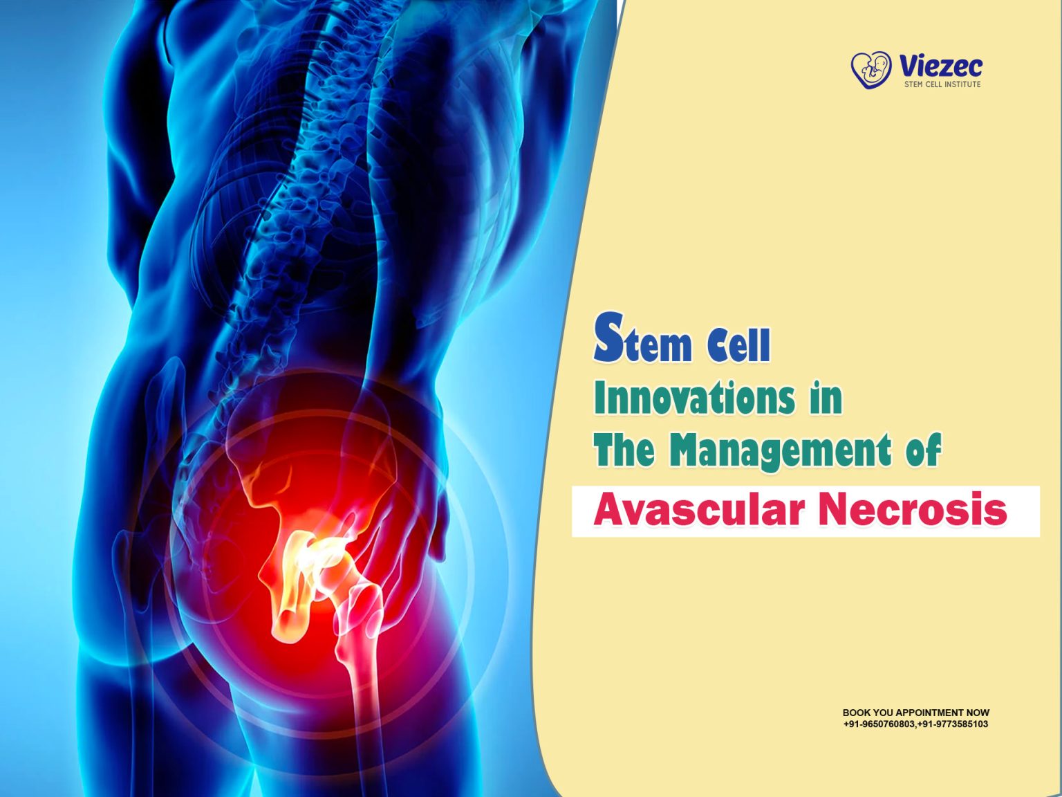 Stem Cell Innovations In The Management Of Avascular Necrosis