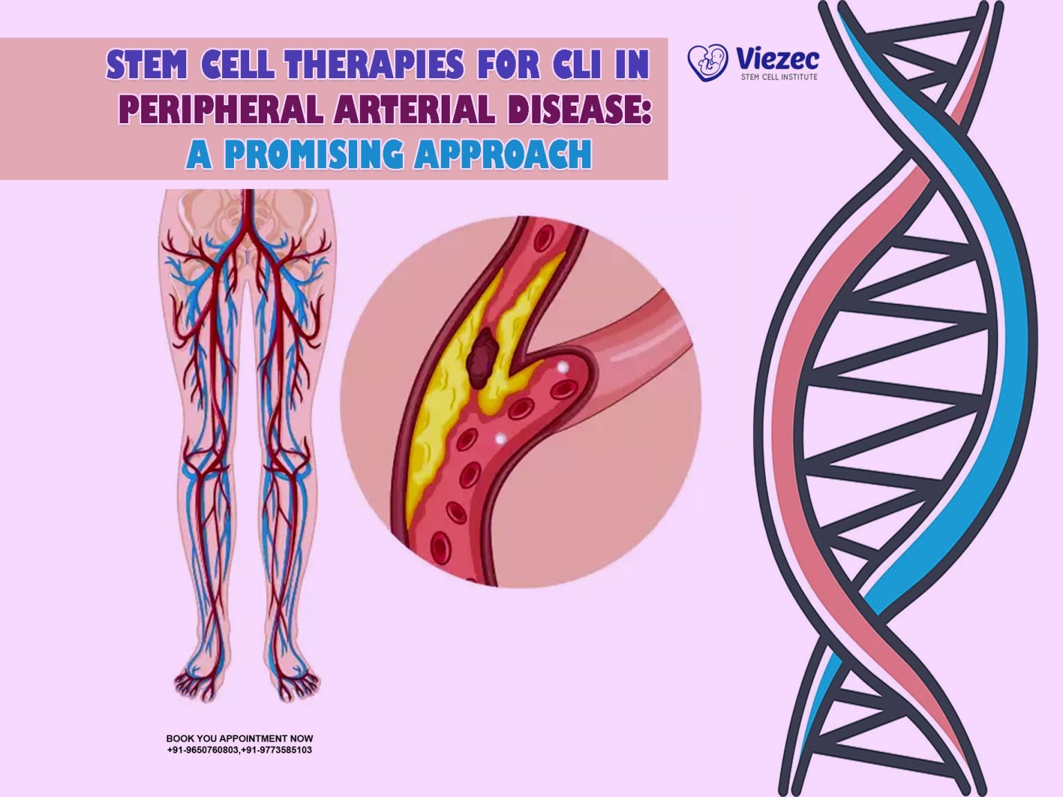 Stem Cell Therapies For CLI In Peripheral Arterial Disease