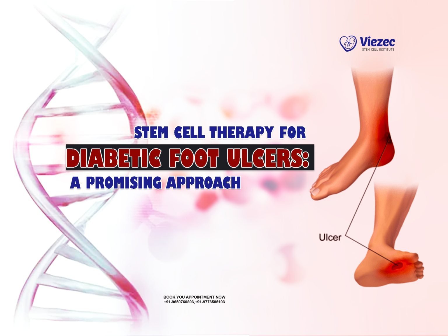 Stem Cell Therapy for Diabetic Foot Ulcers: A Promising Approach