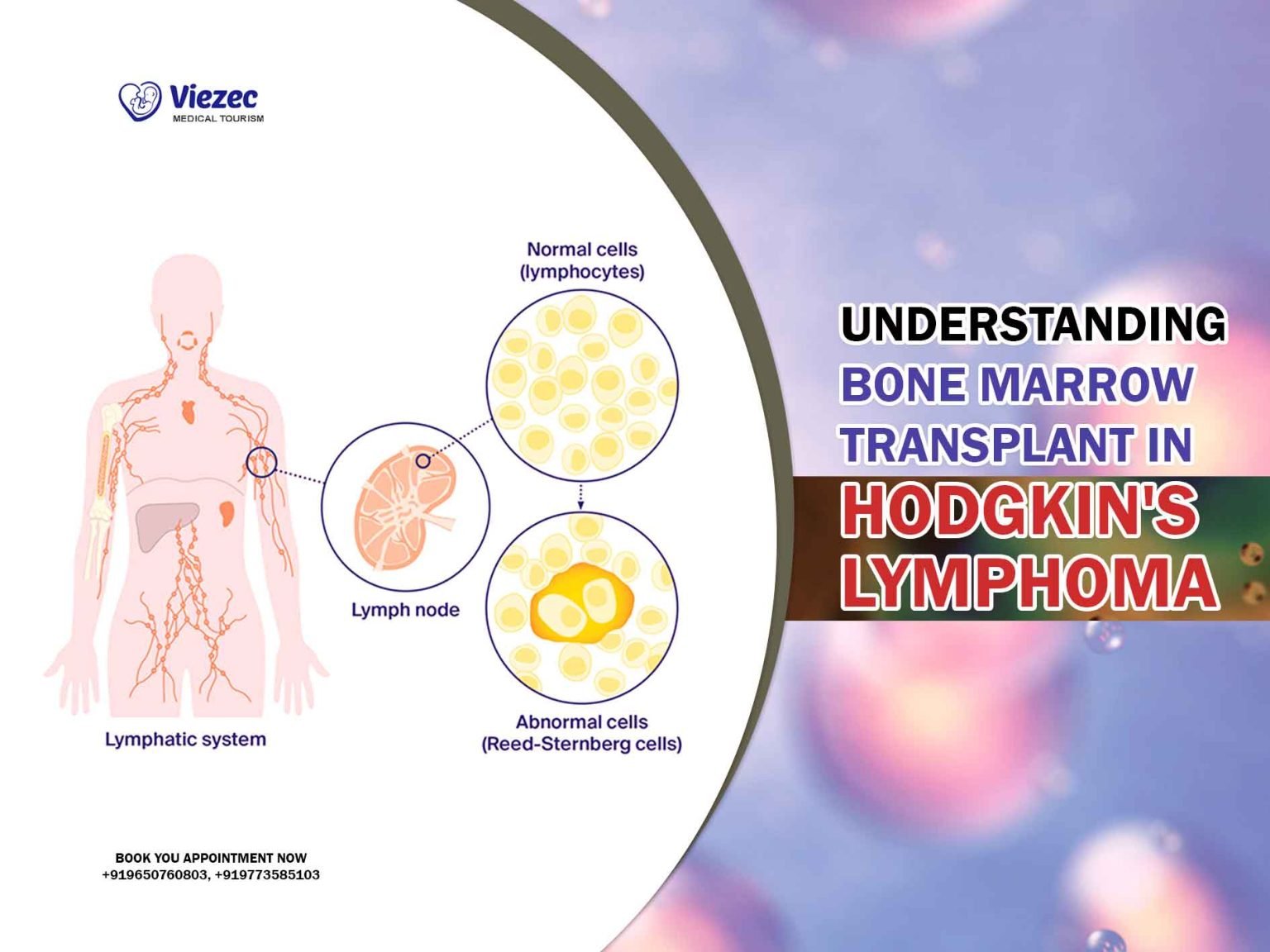 Understanding Bone Marrow Transplant In Hodgkin's Lymphoma