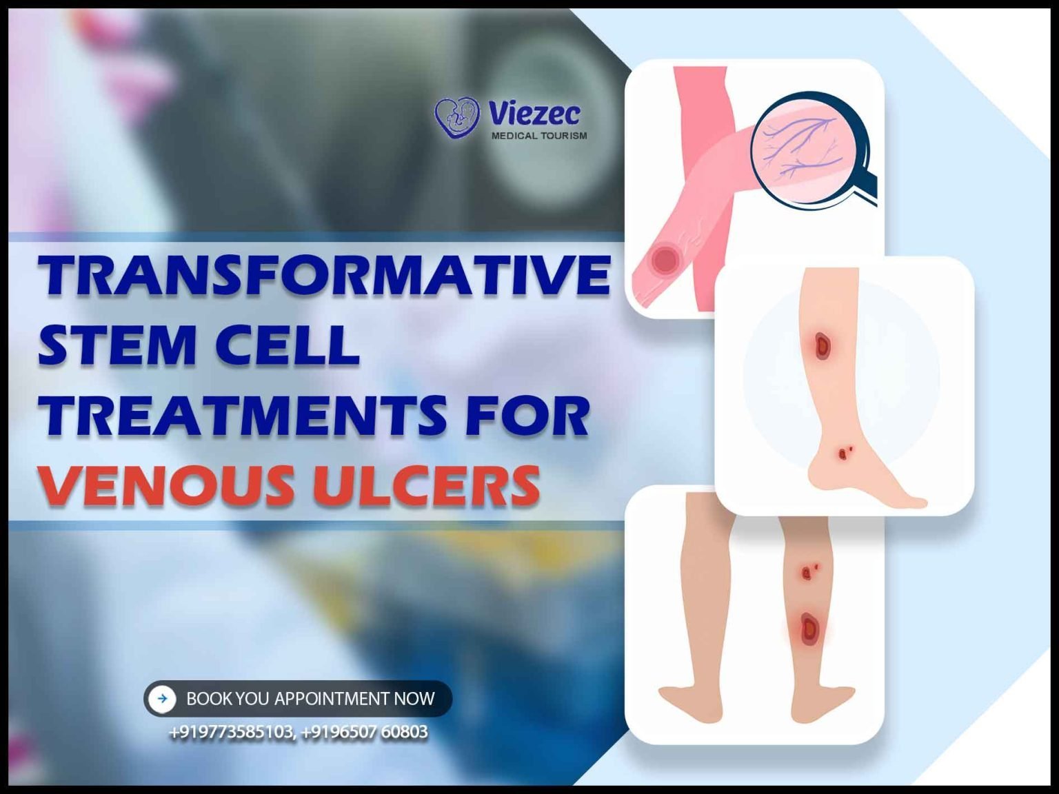 Transformative Stem Cell Treatments For Venous Ulcers