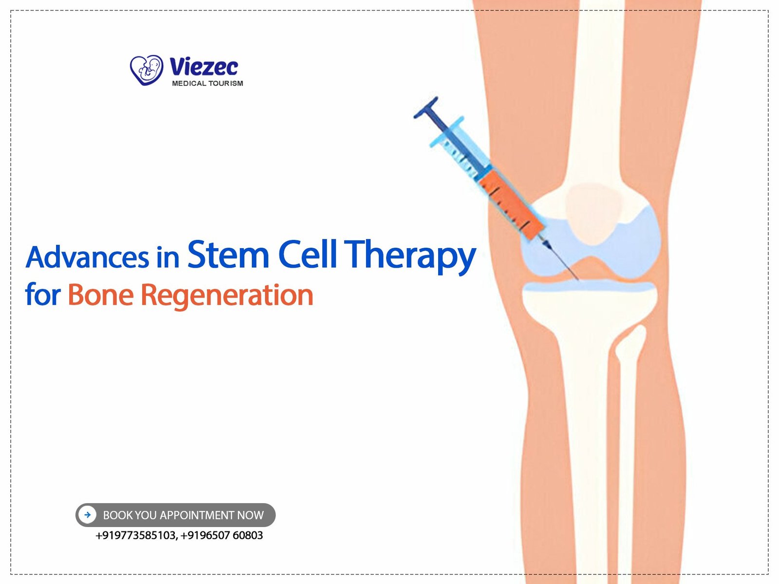 Latest Breakthroughs In Stem Cell Therapy For Bone Regeneration