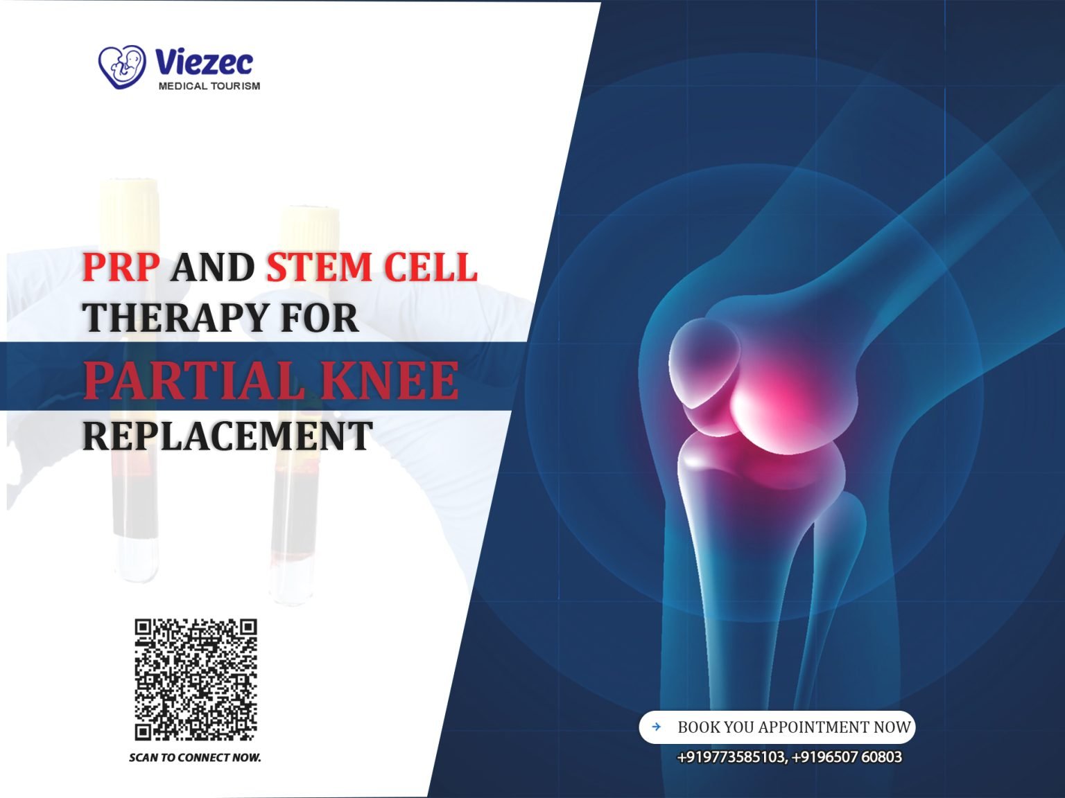 PRP & Stem Cell Therapy For Partial Knee Replacement